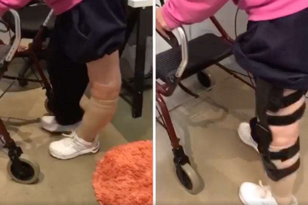 Knee Hyperextension | Orthotics Plus Melbourne